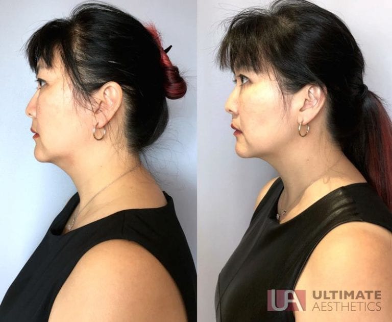 Chin Sculpting Treatment | Ultimate Aesthetics