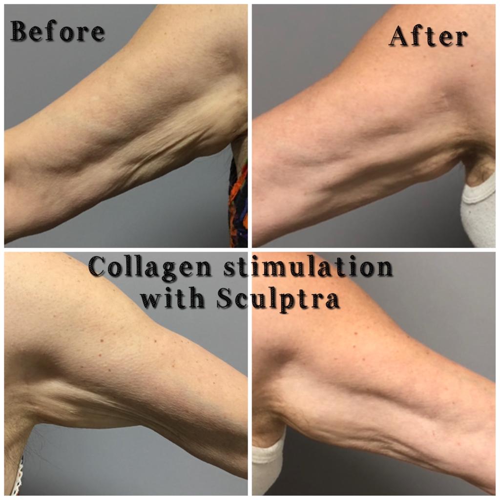 Collagen Biostimulators | Ultimate Aesthetics